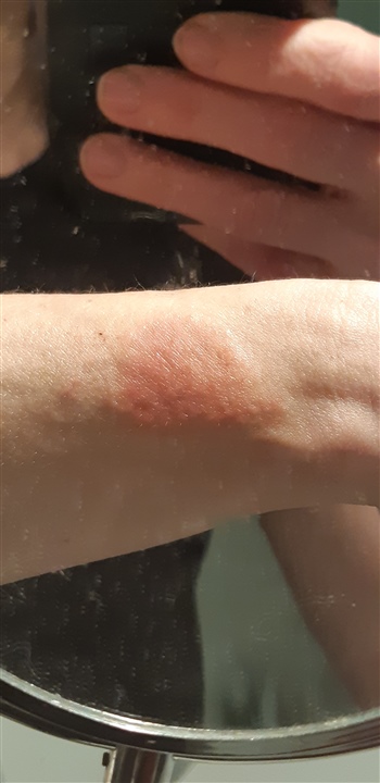 Optical HR and Band rash/burn - vivoactive 3 Series - Sports & Fitness ...